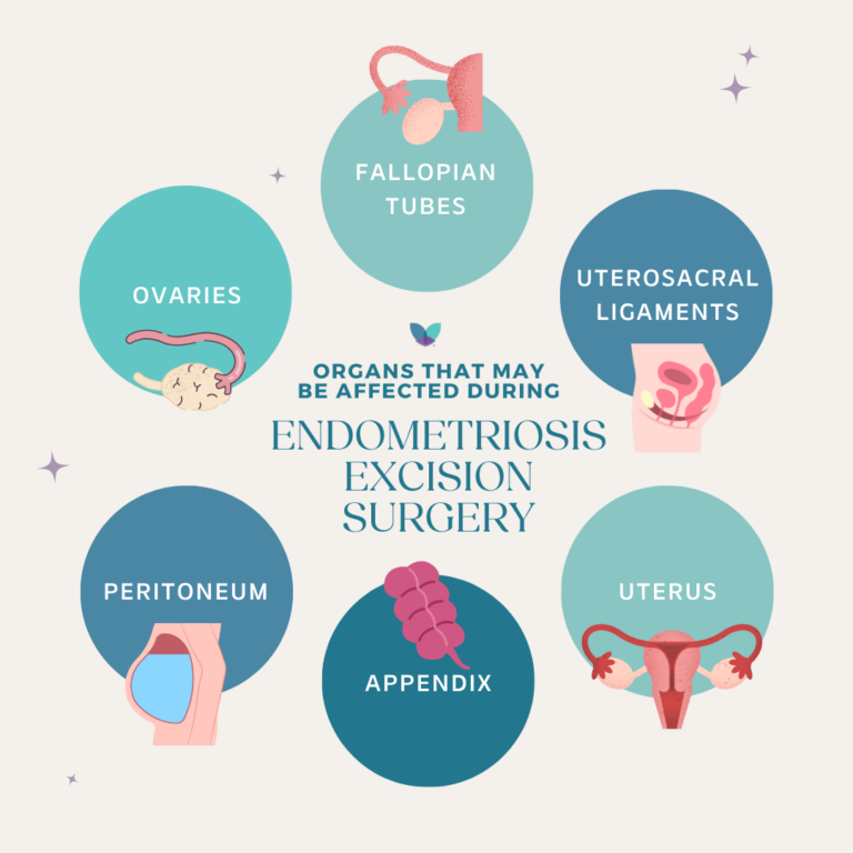 Which Organs Might Be Removed During Endometriosis Surgery? A ...