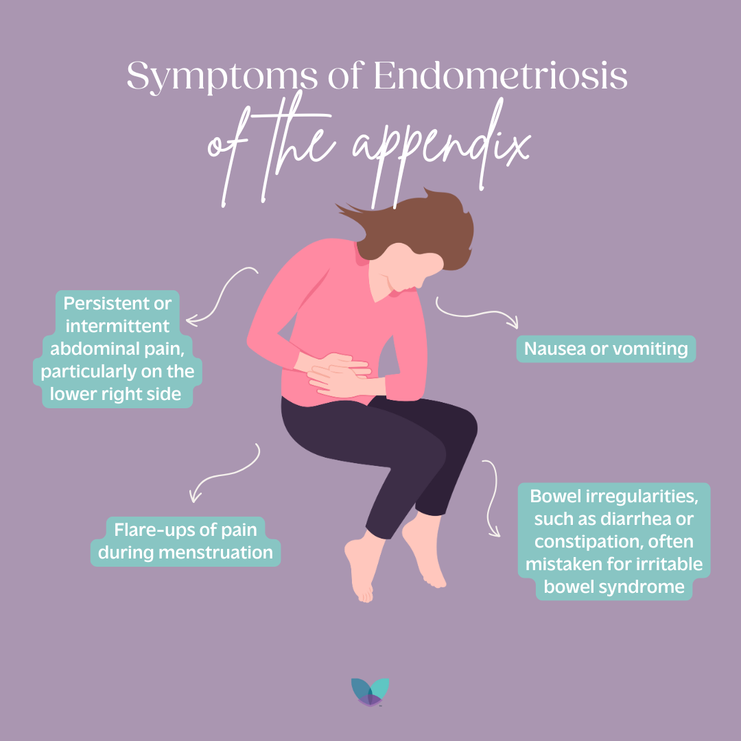 Can Endometriosis Affect Your Appendix? Symptoms and Treatment Insights ...